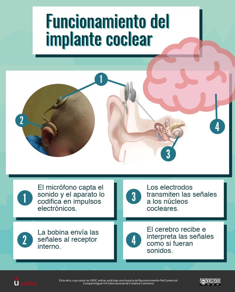 Funcionamiento del implante coclear | Piktochart Visual Editor